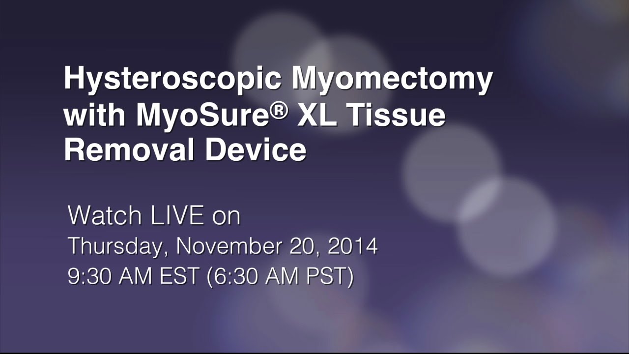 Hysteroscopic Myomectomy with MyoSure® XL Tissue Removal Device