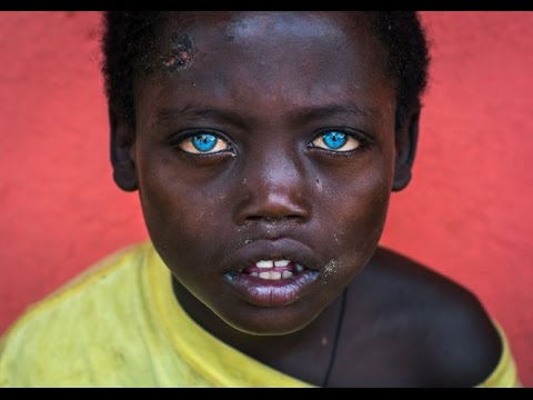 This Boy Has A Rare Physical Disorder That Makes His Eyes Mesmerizing
